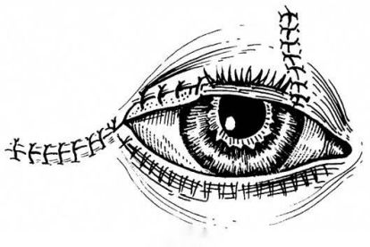 Tenzel旋转皮瓣手术图解-专家文章-博禾医生