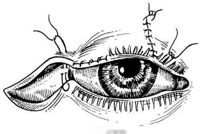 Tenzel旋转皮瓣手术图解-专家文章-博禾医生
