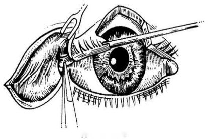 Tenzel旋转皮瓣手术图解-专家文章-博禾医生